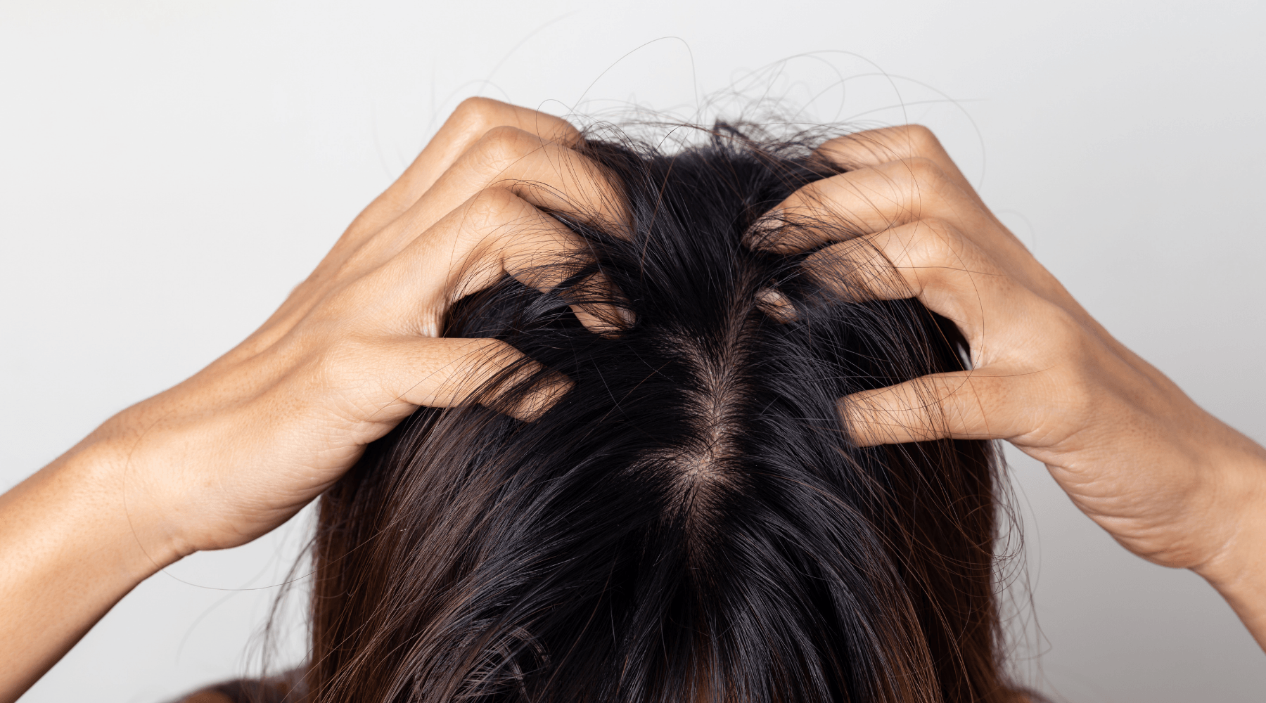 A Guide to Scalp Psoriasis – Oleum Cottage