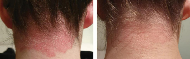 Scalp Psoriasis and Dermatitis 3 Step Care Bundle – Oleum Cottage